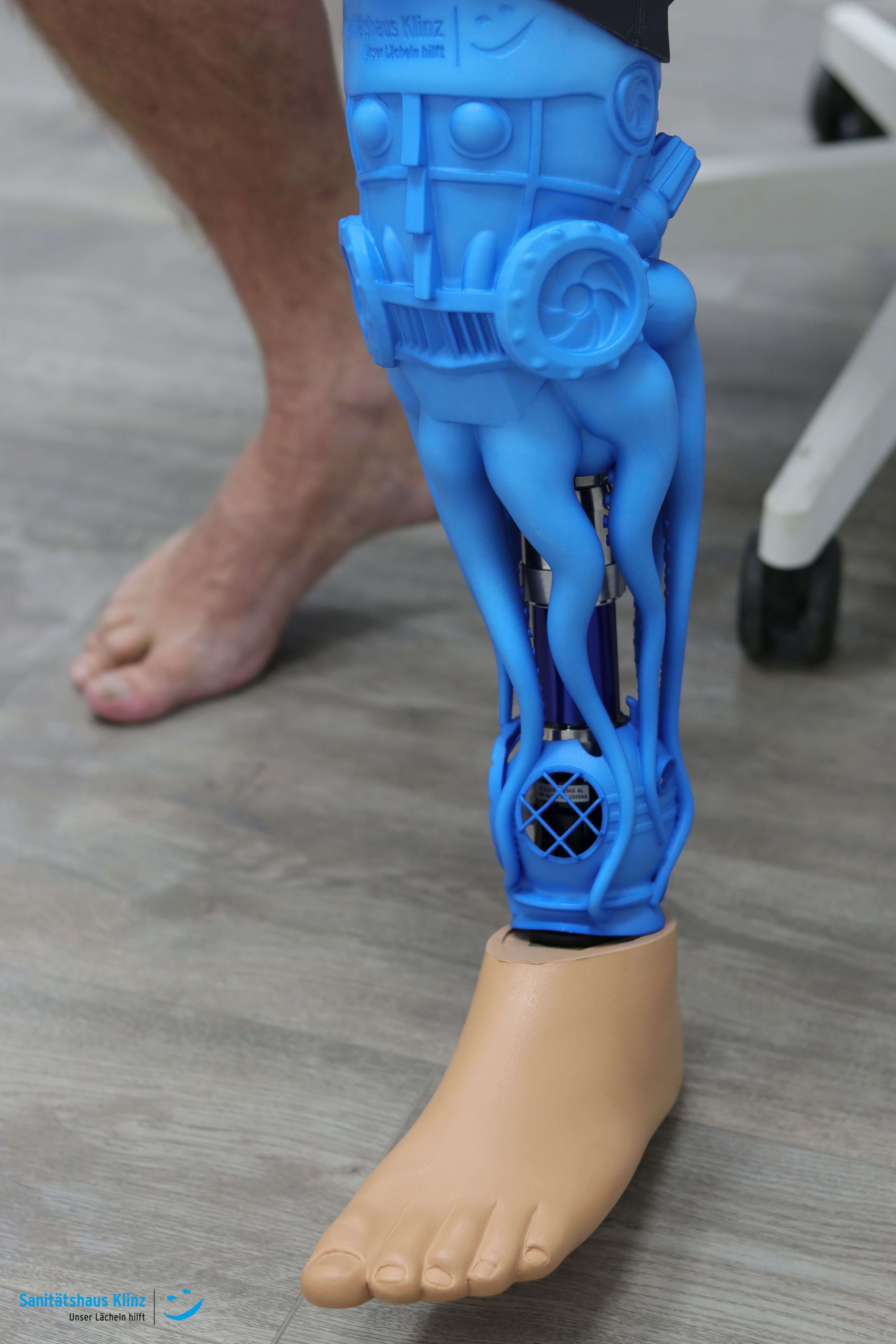 Maßgeschneiderte Prothese mit 3D-Scanning von Artec 3D erstellt