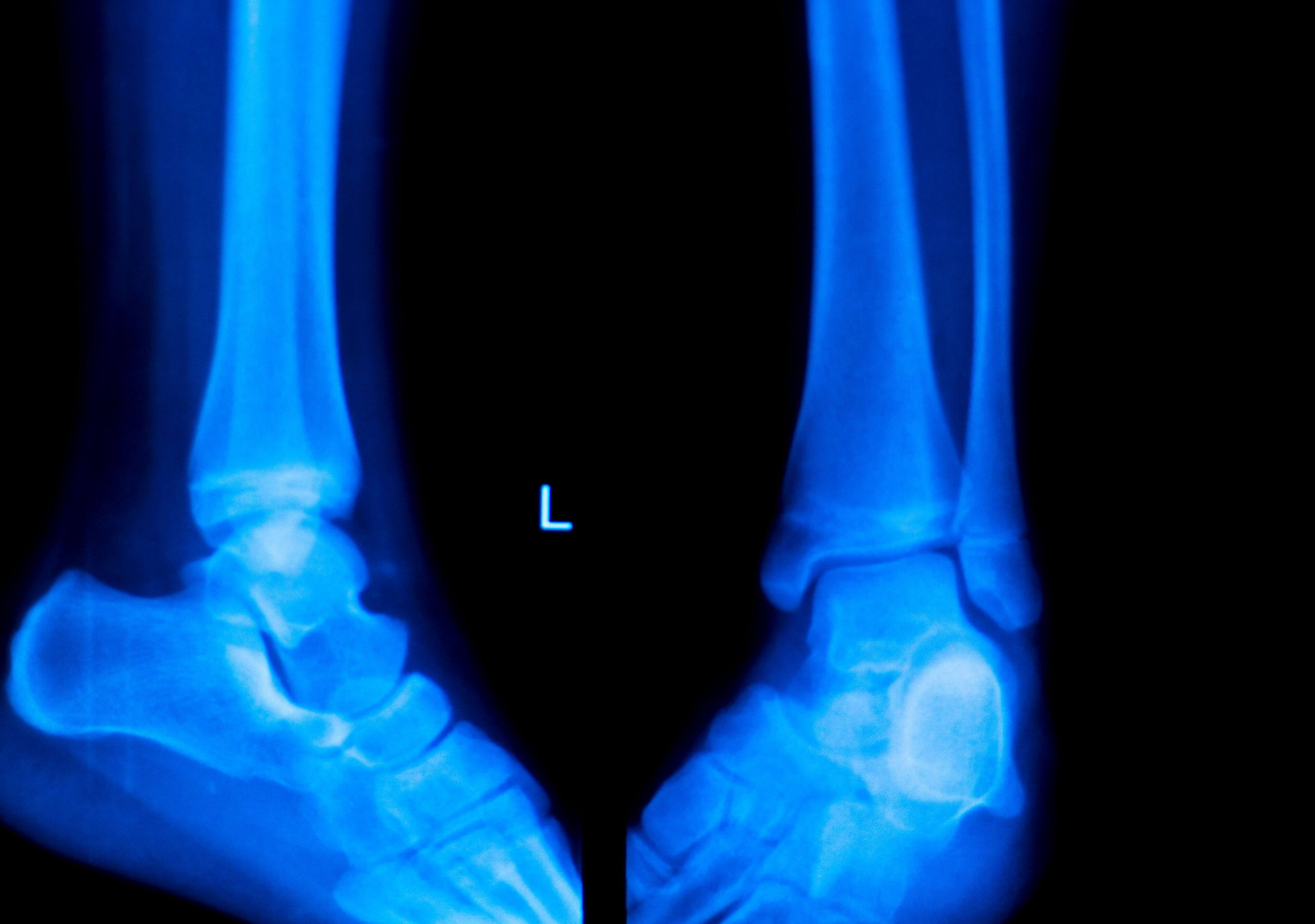 Einzigartiges 3D-gedrucktes Knöchelimplantat bei US-Patientin ...